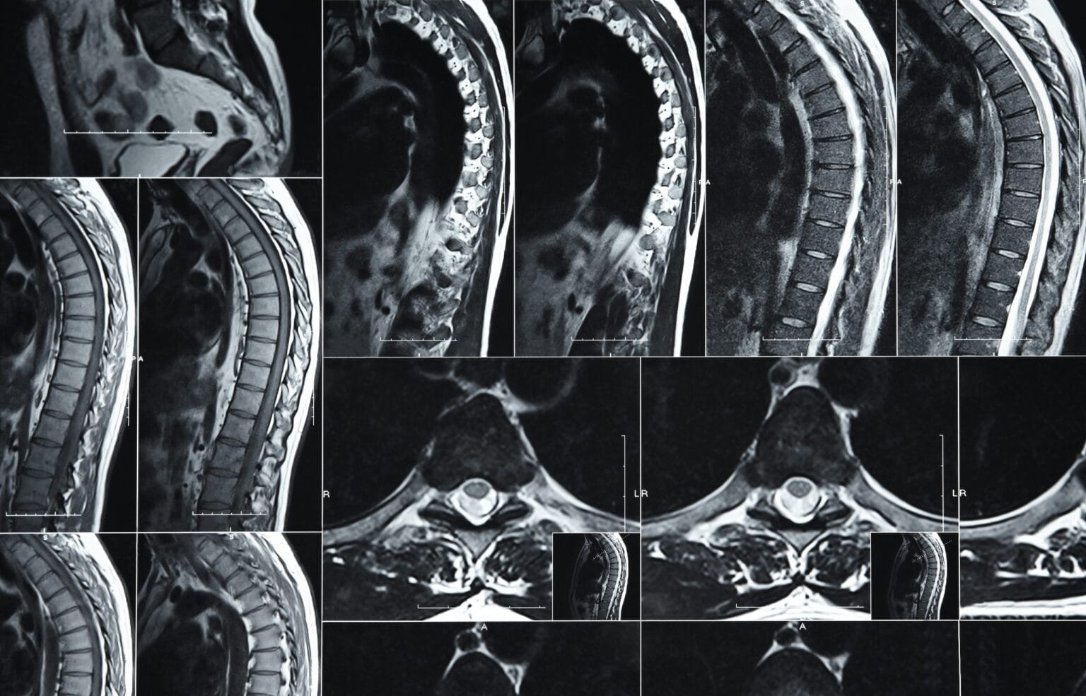 Crucial Understanding: Modic Changes on MRI & What They Mean for Your ...