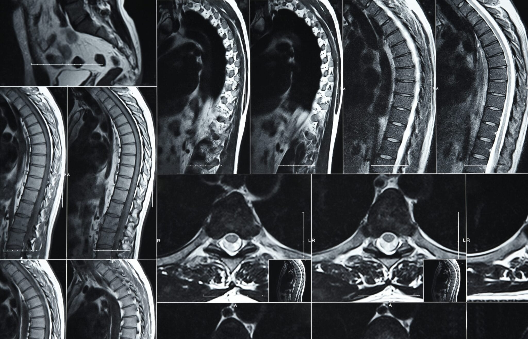 Crucial Understanding: Modic Changes on MRI & What They Mean for Your ...