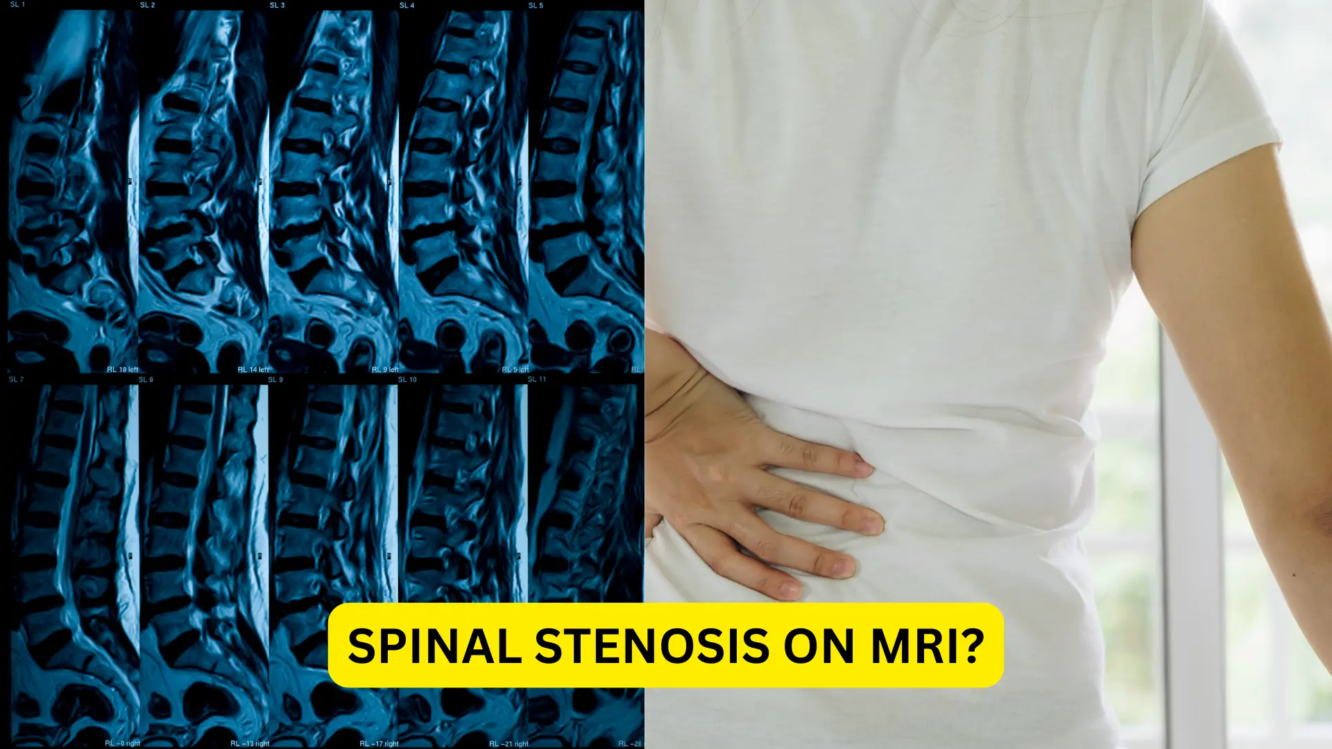 You Got a Spinal Stenosis on MRI for Back Pain—Now What? - Dr. Vivek Arora